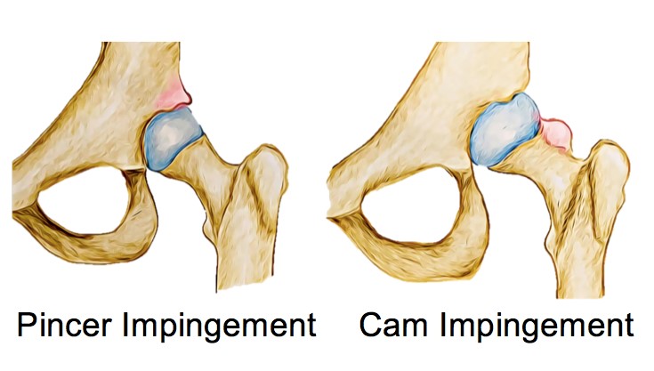 FemoroAcetabular Impingement (FAI): A Brief Summary and the Role of ...